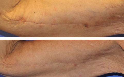 Scar Revision | Beverly Hills Plastic Surgery Group